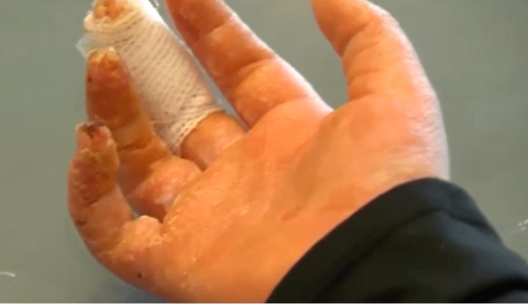 Children Are Burning Their Hands When Trying This New Schoolyard Craze ...