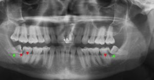 Scientists Claim That More Babies Born Without Wisdom Teeth And With ...