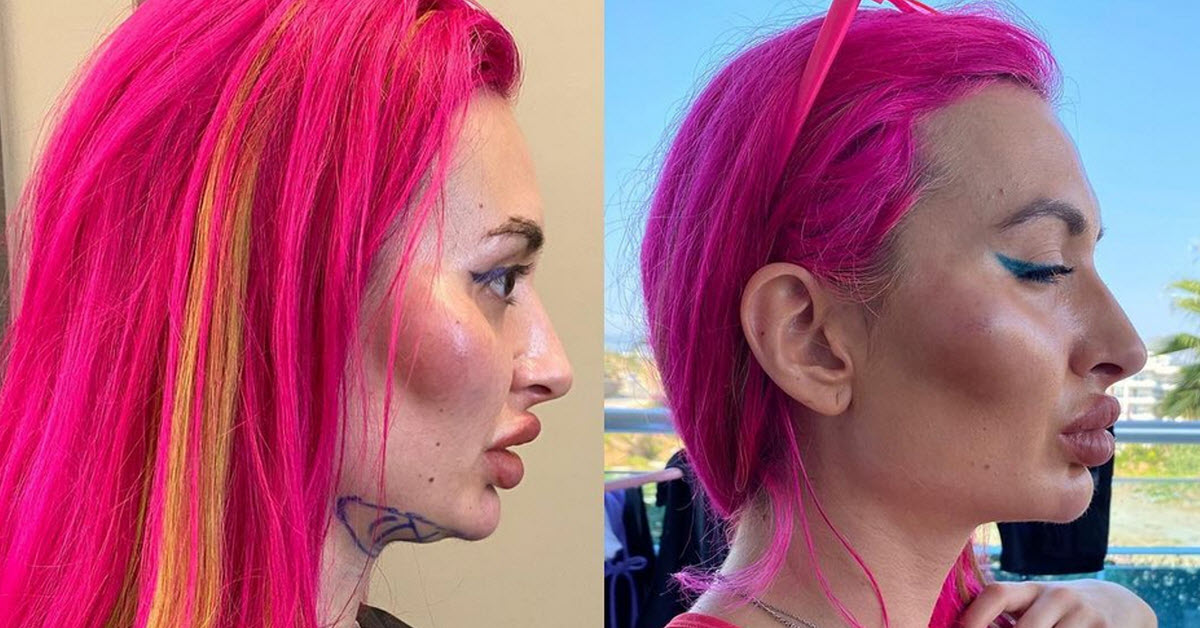 Influencer On Social Media Has The Biggest Cheeks And Wants Them Bigger ...