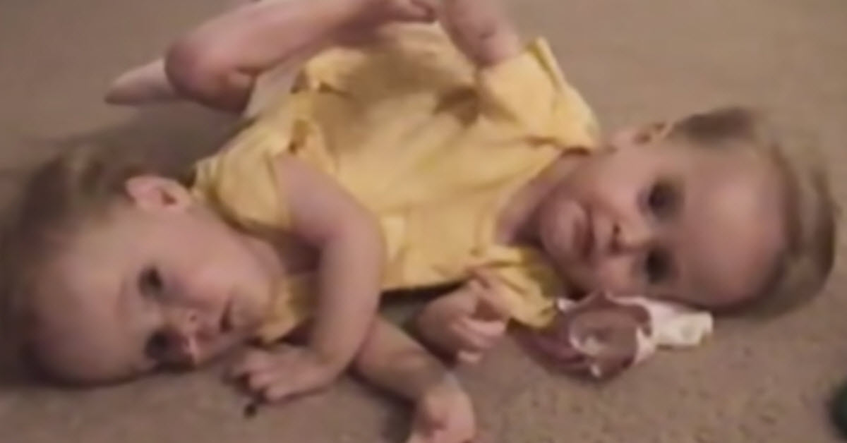 Twin Sisters Were ‘Cut In Half’ But They Are Living The Best Life ...