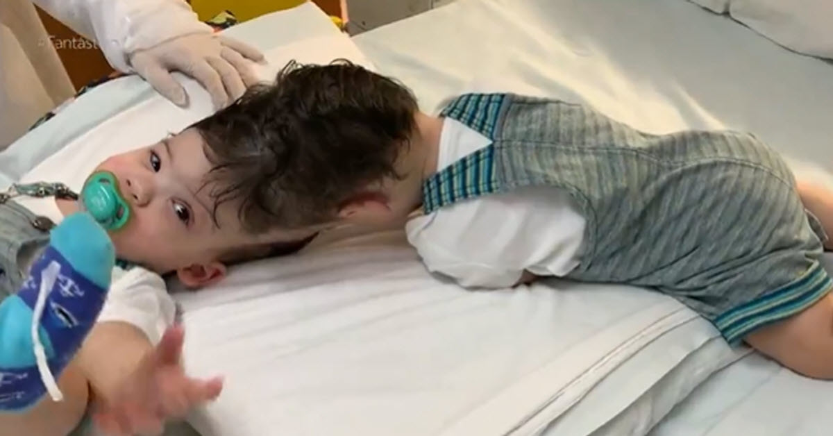 Cojoined Twins With Fused Brain Are Separated In A Miracle Operation At ...