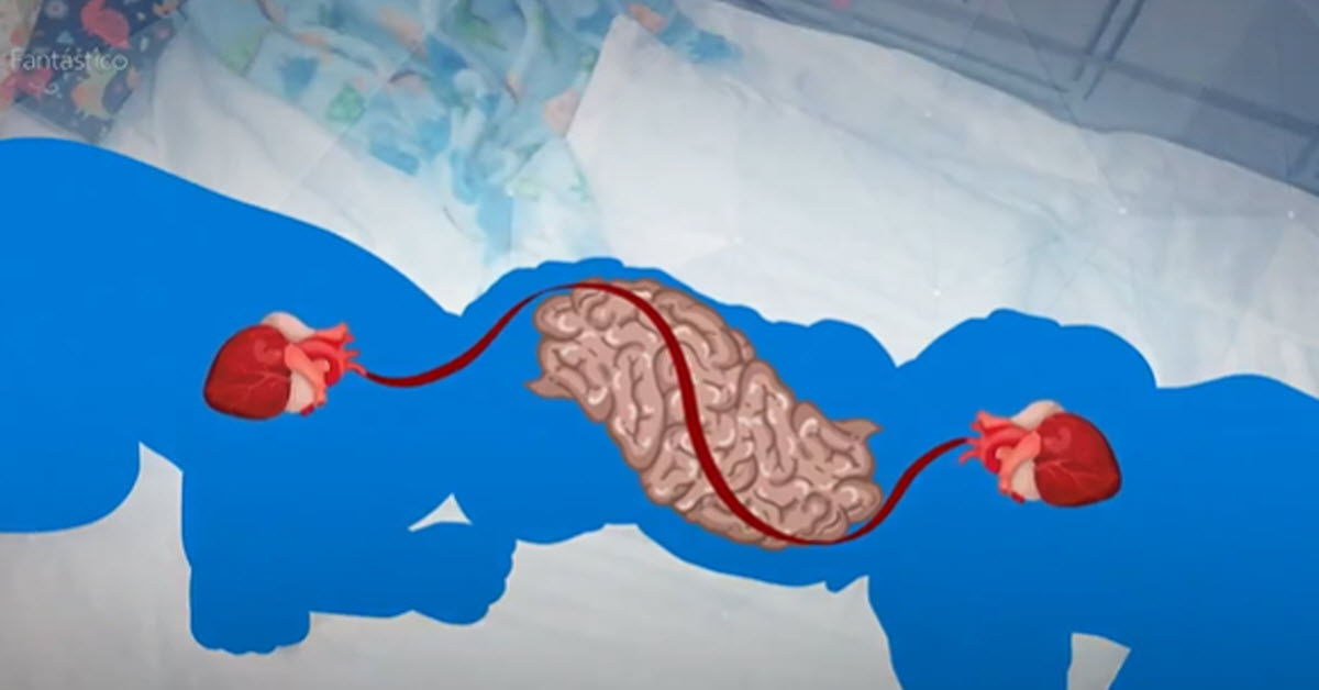 Cojoined Twins With Fused Brain Are Separated In A Miracle Operation At ...